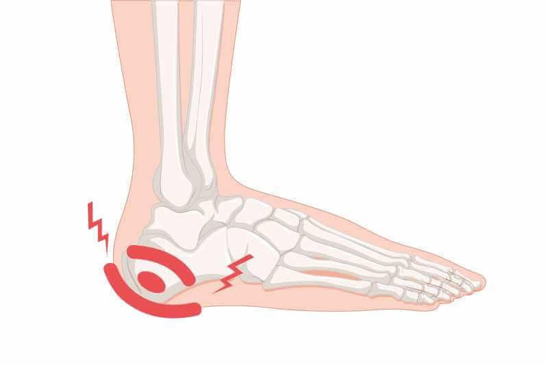 Fußballen schmerzen | Liebscher & Bracht Zentrum Hamburg